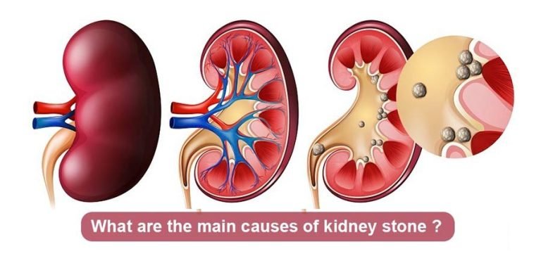 Kidney stone: Symptoms and illness - Fusion HealthCare