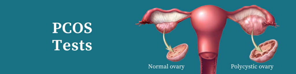 Polycystic Ovarian syndrome (PCOS) - Fusion HealthCare